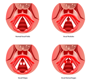 Vocal Health for Singers: Preventing and Recovering from Vocal Damage ...